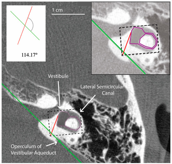 2D Measurements of the Angle of the Vestibular Aqueduct Using CT Imaging
