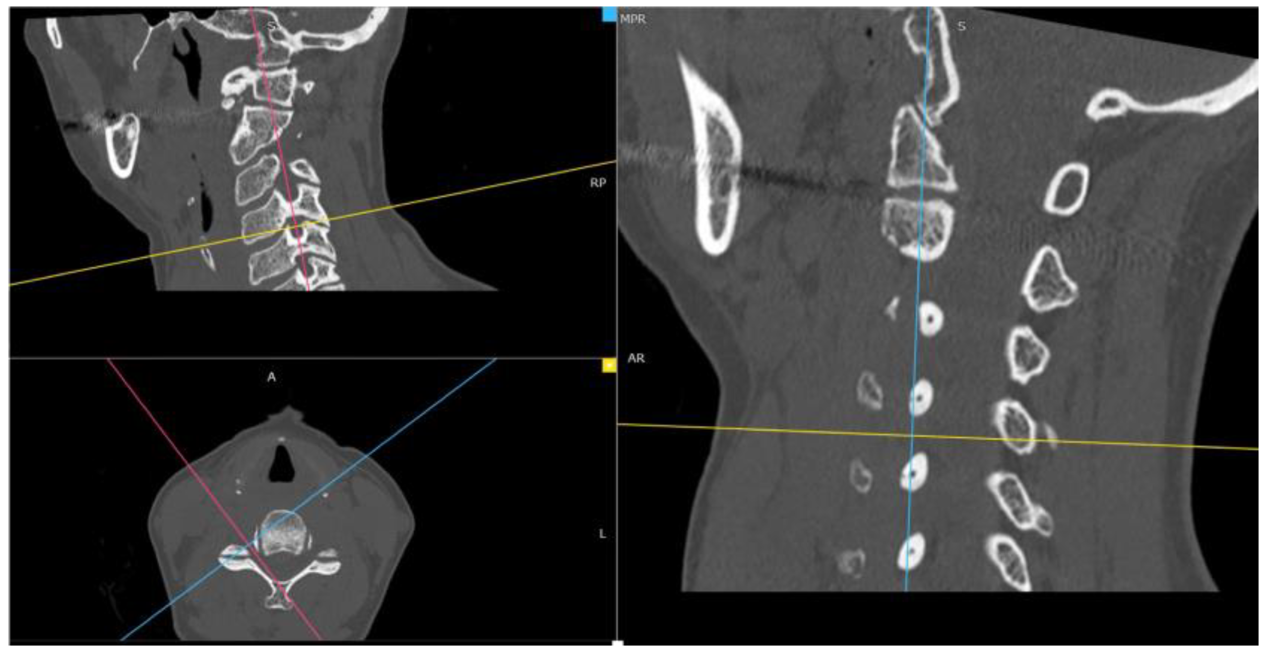The Impact of Single-Level ACDF on Neural Foramen and Disc Height of ...