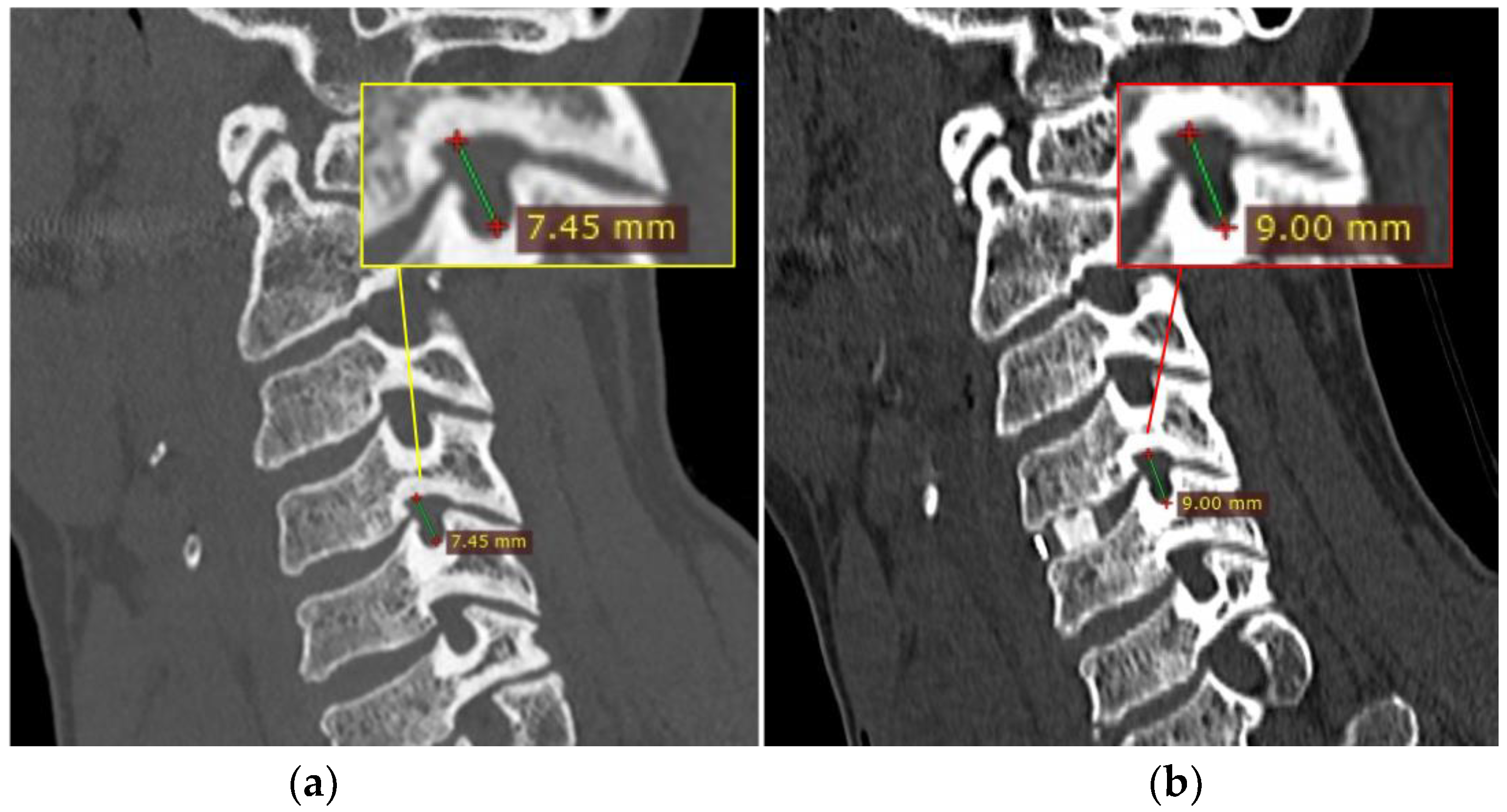 Brain Sciences Free Full Text The Impact Of Single Level Acdf On