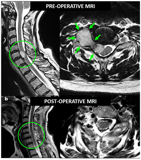 Sacrifice of Involved Nerve Root during Surgical Resection of Foraminal ...