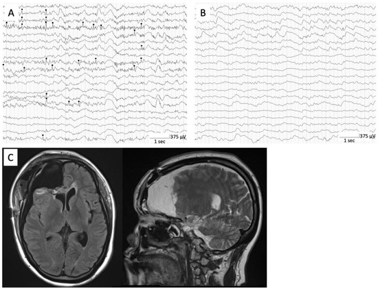 Frontal Encephalocele Plus Epilepsy: A Case Report and Review of the ...