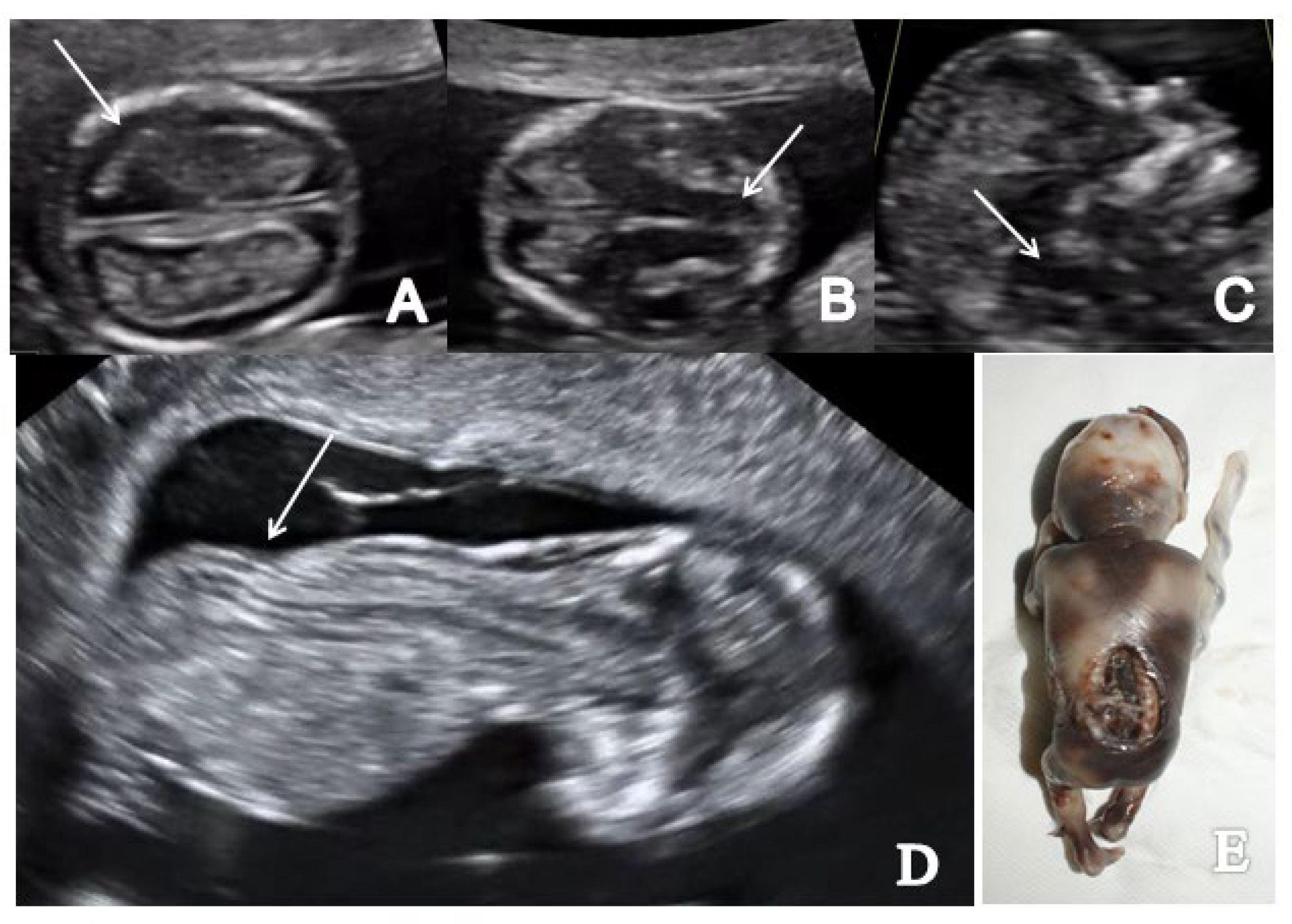 First Trimester Ultrasound Detection of Fetal Central Nervous System Anomalies