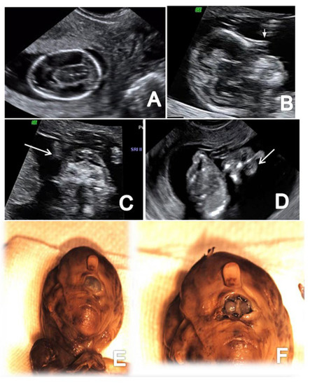 First Trimester Ultrasound Detection of Fetal Central Nervous System Anomalies
