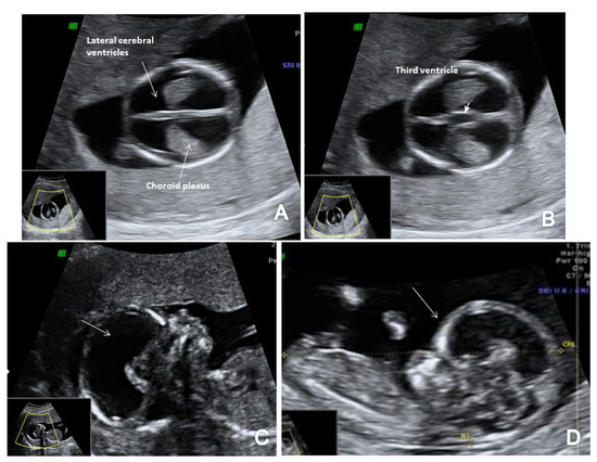 First Trimester Ultrasound Detection of Fetal Central Nervous System Anomalies