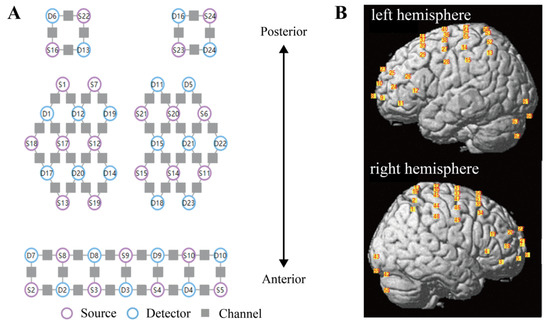 Neuroplasticity Elicited by Modified Pharyngeal Electrical Stimulation ...