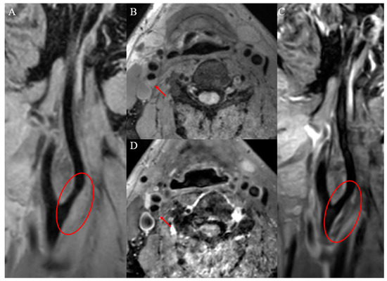 Imaging and Hemodynamic Characteristics of Vulnerable Carotid Plaques ...