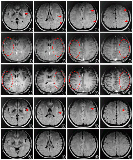 Anti-MOG Antibody-Associated Unilateral Cortical Encephalitis with ...