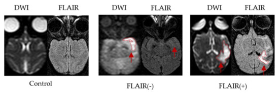 CDC42 Might Be a Molecular Signature of DWI-FLAIR Mismatch in a ...