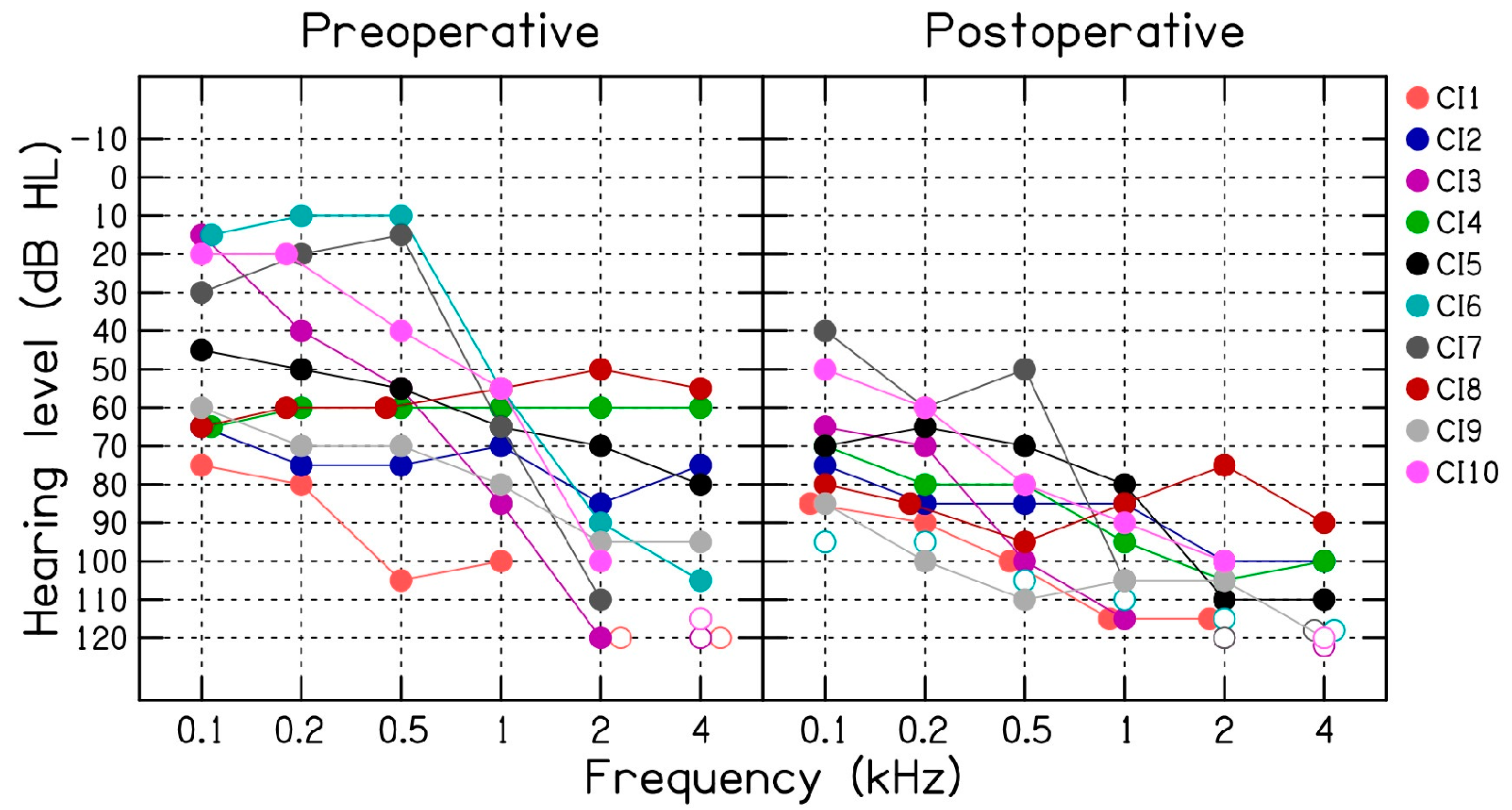 Multi-Frequency Electrocochleography and Electrode Scan to Identify ...