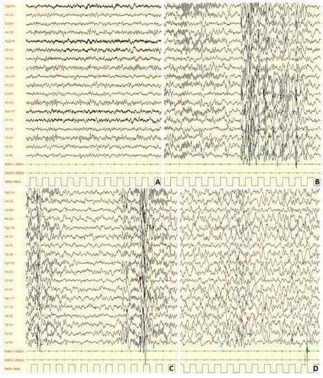 EEG Features in Autism Spectrum Disorder: A Retrospective Analysis in a ...
