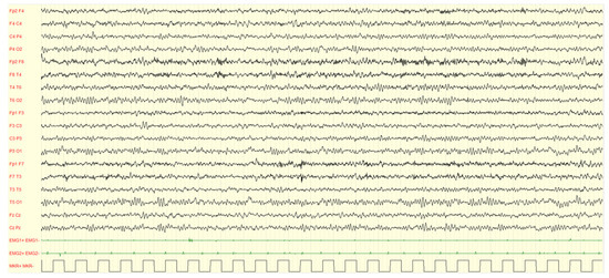 EEG Features in Autism Spectrum Disorder: A Retrospective Analysis in a ...