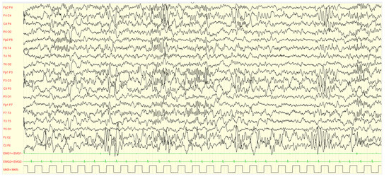 EEG Features in Autism Spectrum Disorder: A Retrospective Analysis in a ...