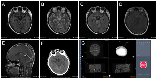 A Comparison of the Safety, Efficacy, and Accuracy of Frame-Based ...