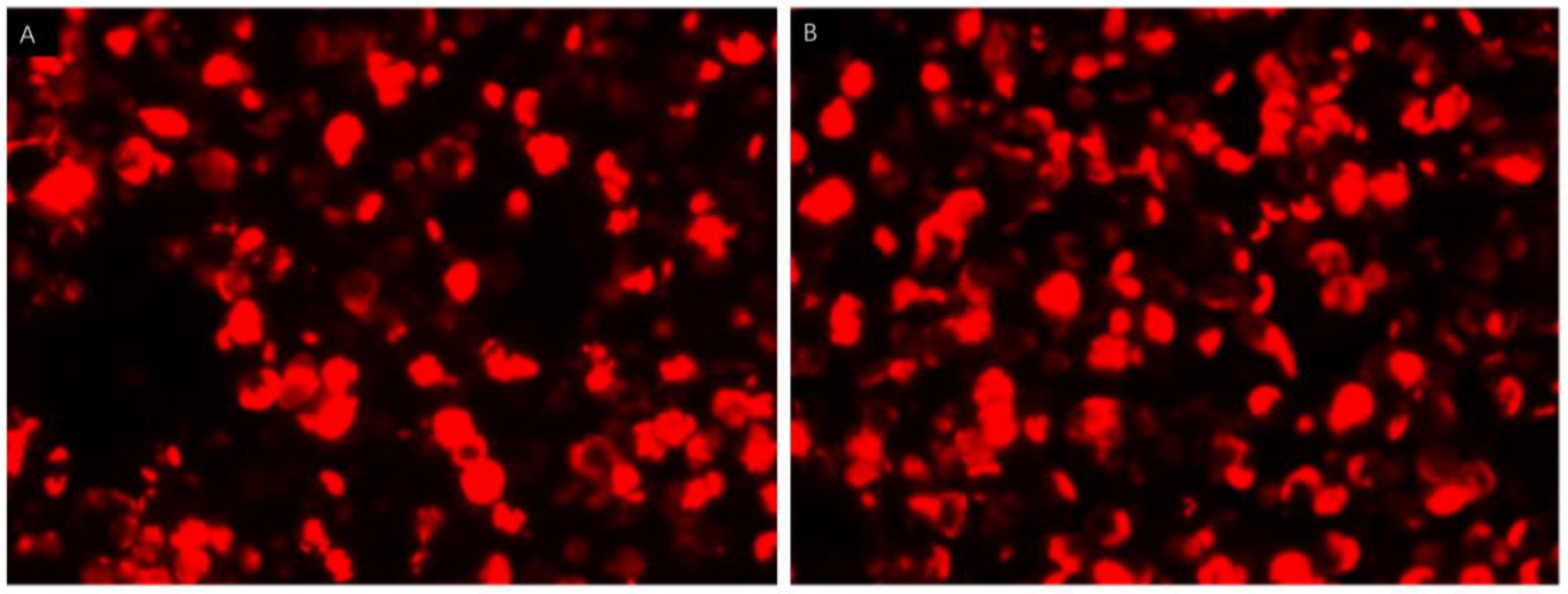 A Case of Anti-GAD 65 Autoimmune Encephalitis Associated with Focal ...