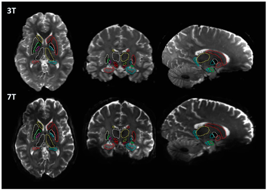 Diffusion Measures of Subcortical Structures Using High-Field MRI