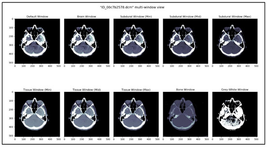 An Efficient Framework to Detect Intracranial Hemorrhage Using Hybrid ...