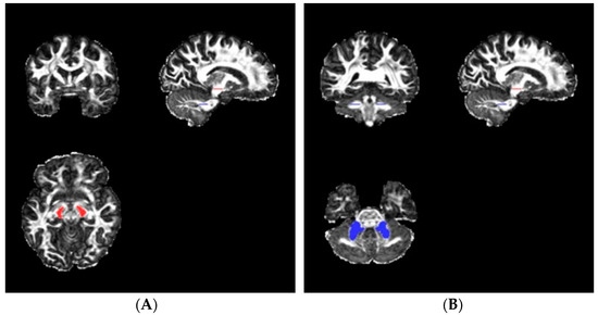 Long-Term Lower Limb Motor Function Correlates with Middle Cerebellar ...