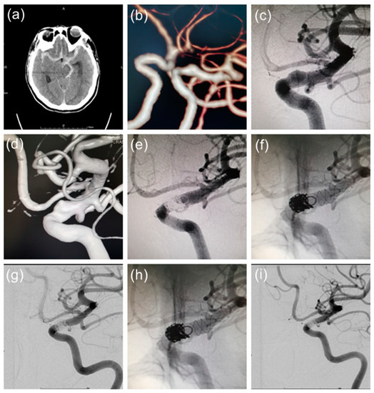 Flow Diverter Device-Assisted Coiling Treatment for Cerebral Blister ...