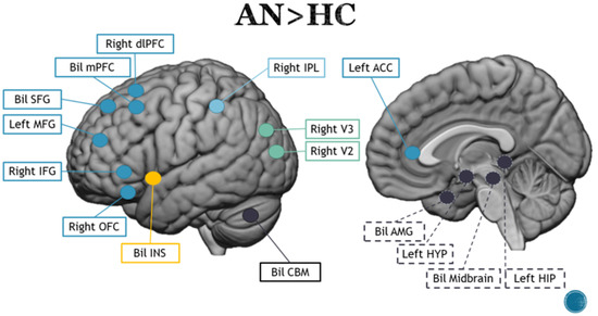Brain Correlates of Eating Disorders in Response to Food Visual Stimuli ...