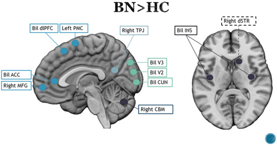 Brain Correlates of Eating Disorders in Response to Food Visual Stimuli ...