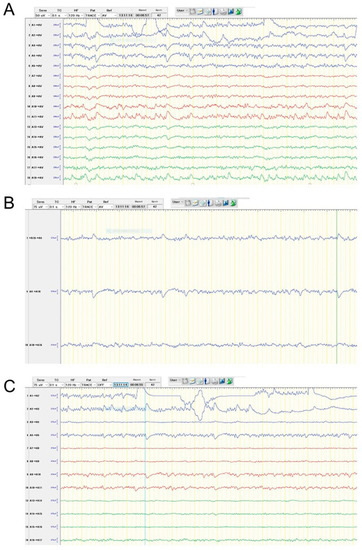 Applied Fence-Post Techniques Using Deep Electrodes Instead of ...