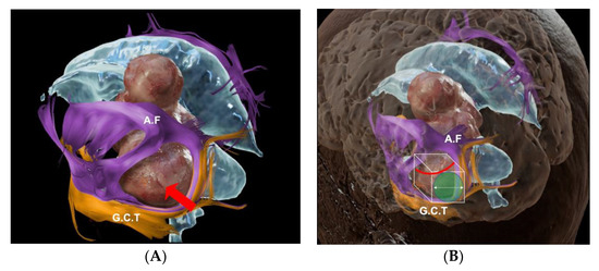Standardization of Strategies to Perform a Parafascicular Tubular ...
