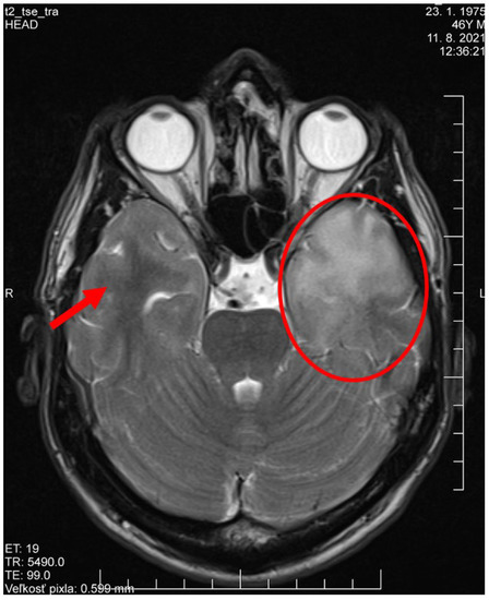 Neurosyphilis Presenting as Syndrome of Limbic Encephalitis Mimicking ...