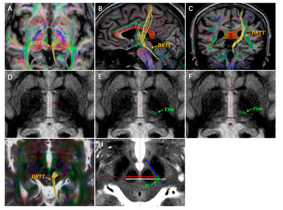 Technical Issues of Vim–PSA Double-Target DBS for Essential Tremor