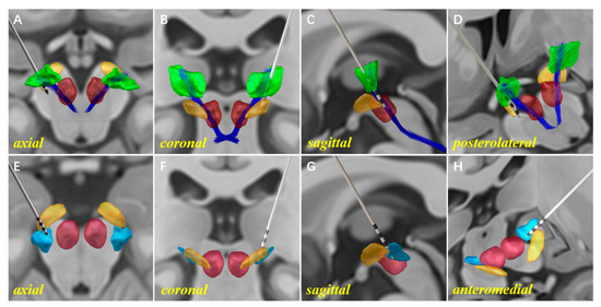 Technical Issues of Vim–PSA Double-Target DBS for Essential Tremor