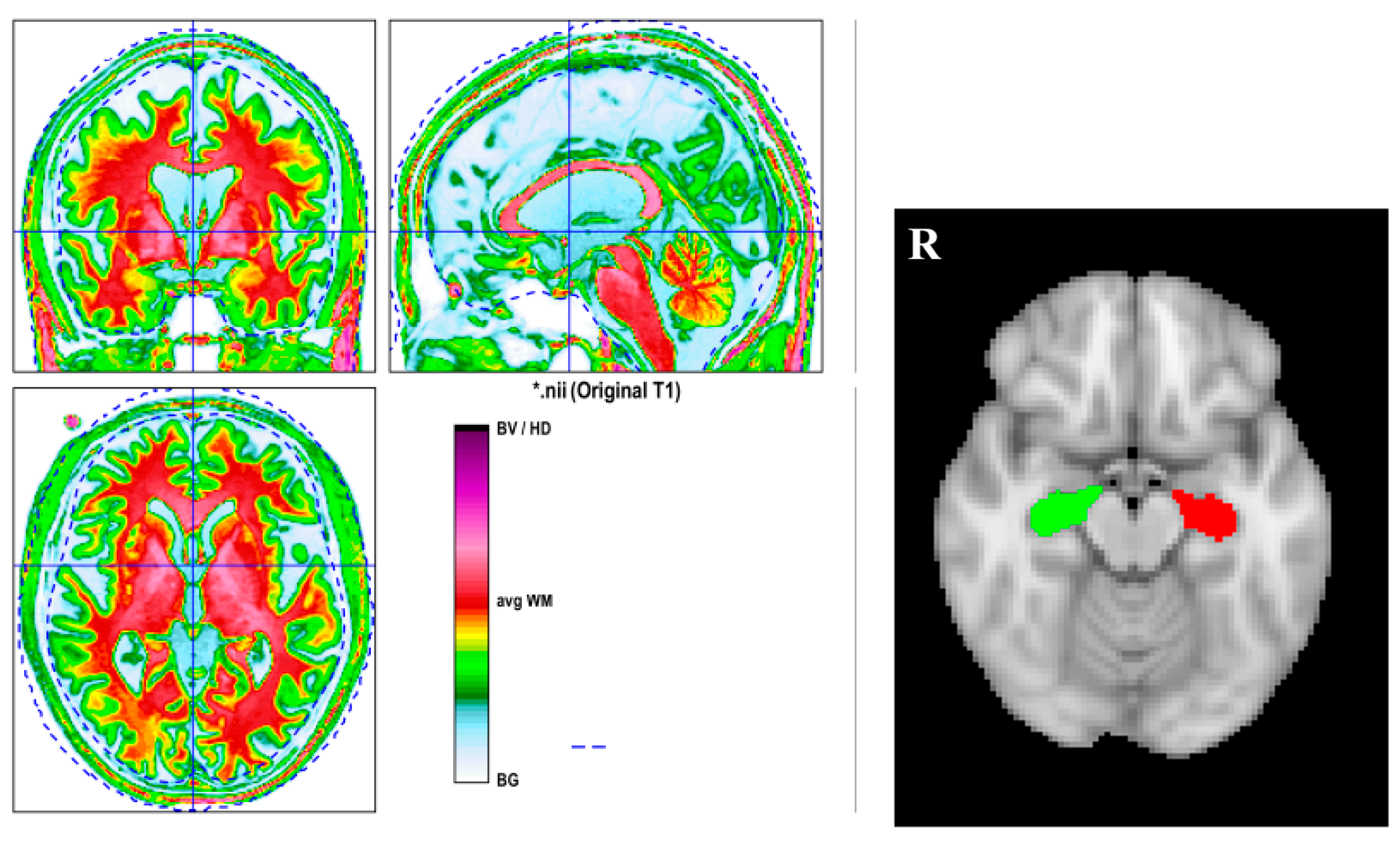 The Use of Diffusion Kurtosis Imaging for the Differential Diagnosis of Alzheimer’s Disease Spectrum