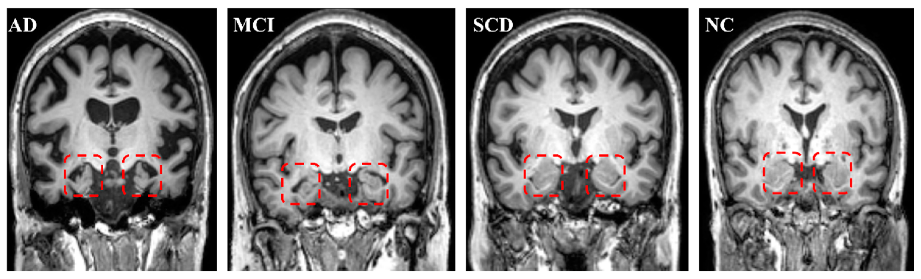 The Use of Diffusion Kurtosis Imaging for the Differential Diagnosis of ...