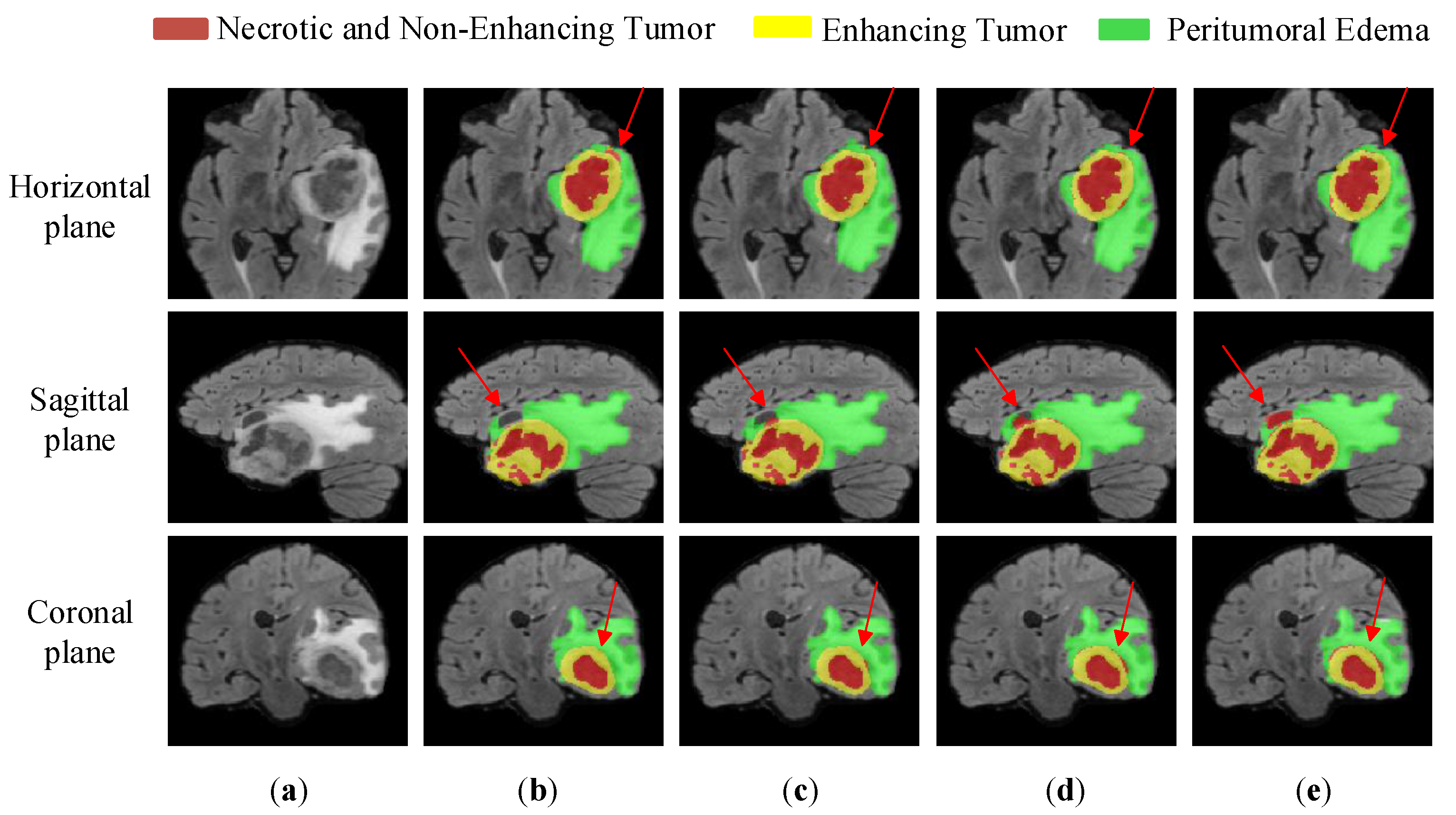 Brain Sciences | Free Full-Text | Brain Tumor Segmentation Network with ...
