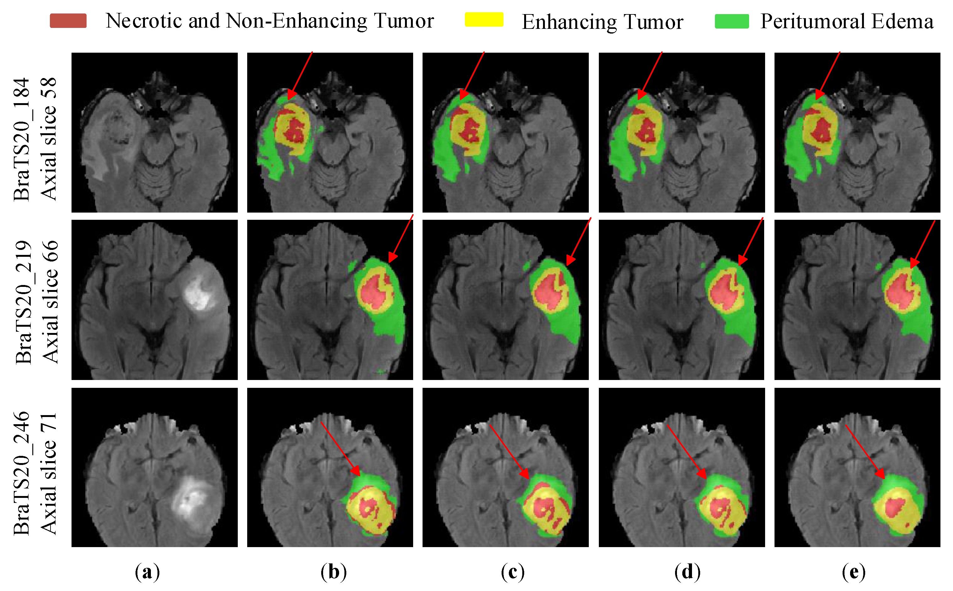 Brain Sciences | Free Full-Text | Brain Tumor Segmentation Network with Multi-View Ensemble ...