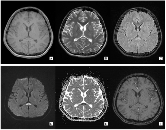 Autoimmune Glial Fibrillary Acidic Protein (Gfap) Astrocytopa-Thy ...