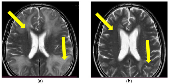 Cerebral Amyloid Angiopathy-Related Inflammation (CAA-rI): Three ...
