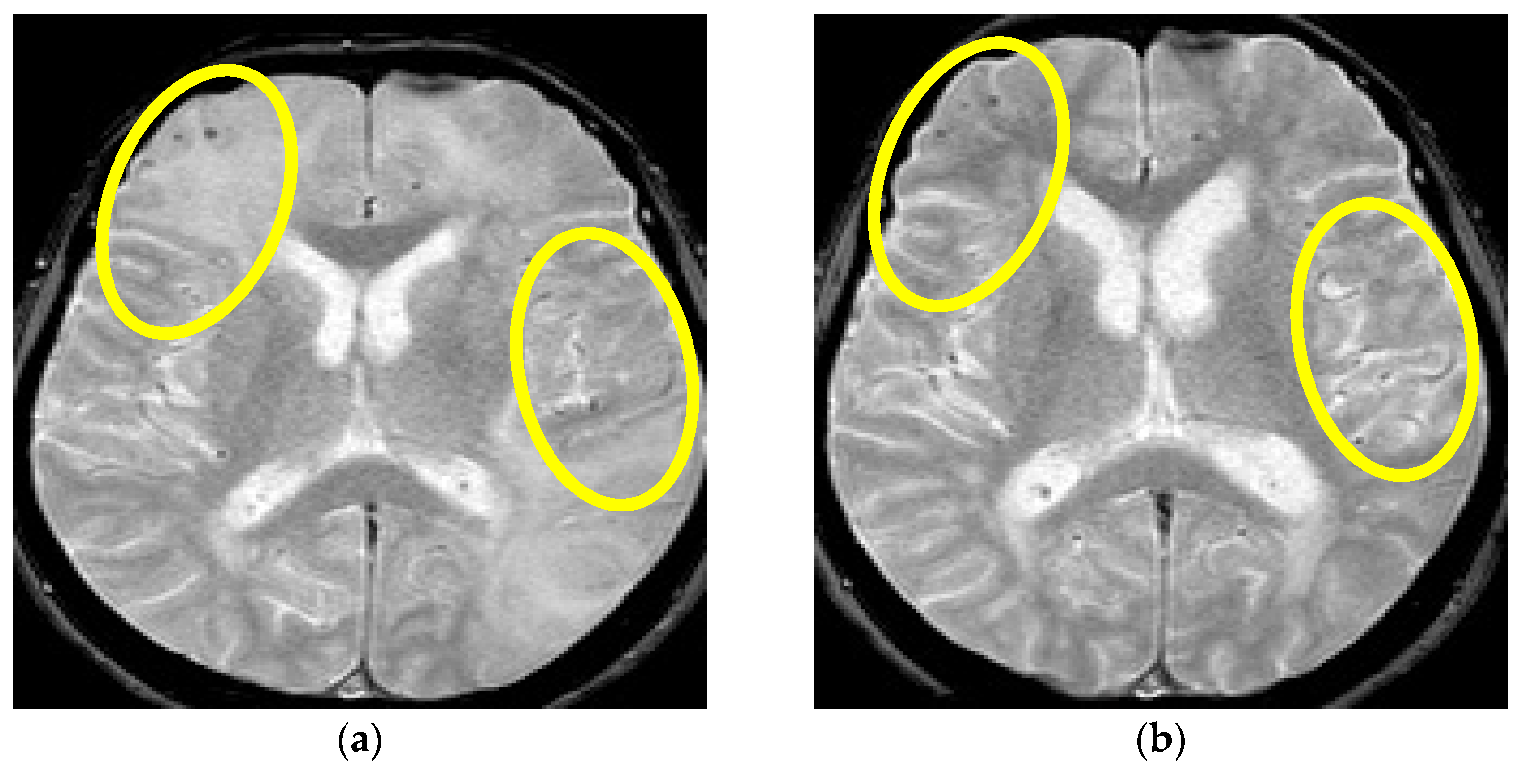 Brain Sciences | Free Full-Text | Cerebral Amyloid Angiopathy-Related ...