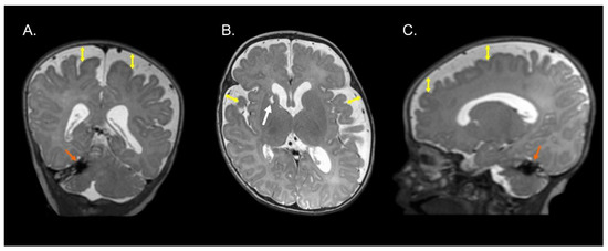 Brain Sciences | Free Full-Text | Prevention of Neurological Sequelae ...