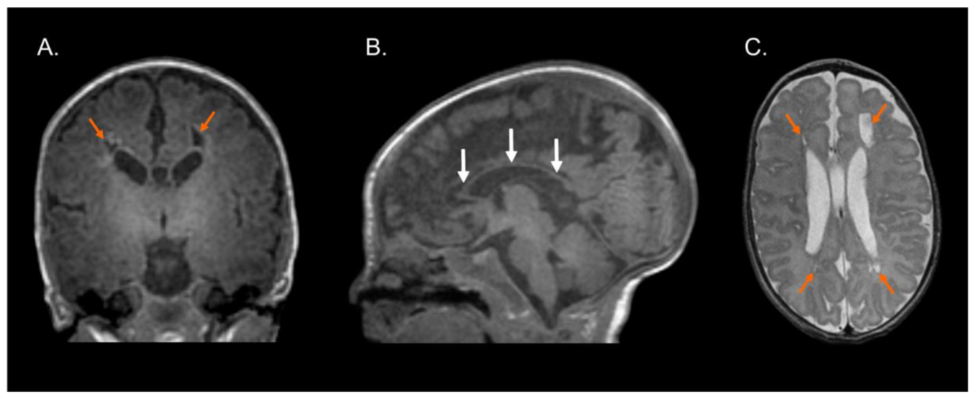 Brain Sciences | Free Full-Text | Prevention of Neurological Sequelae ...