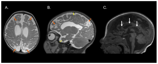 Brain Sciences | Free Full-Text | Prevention of Neurological Sequelae ...