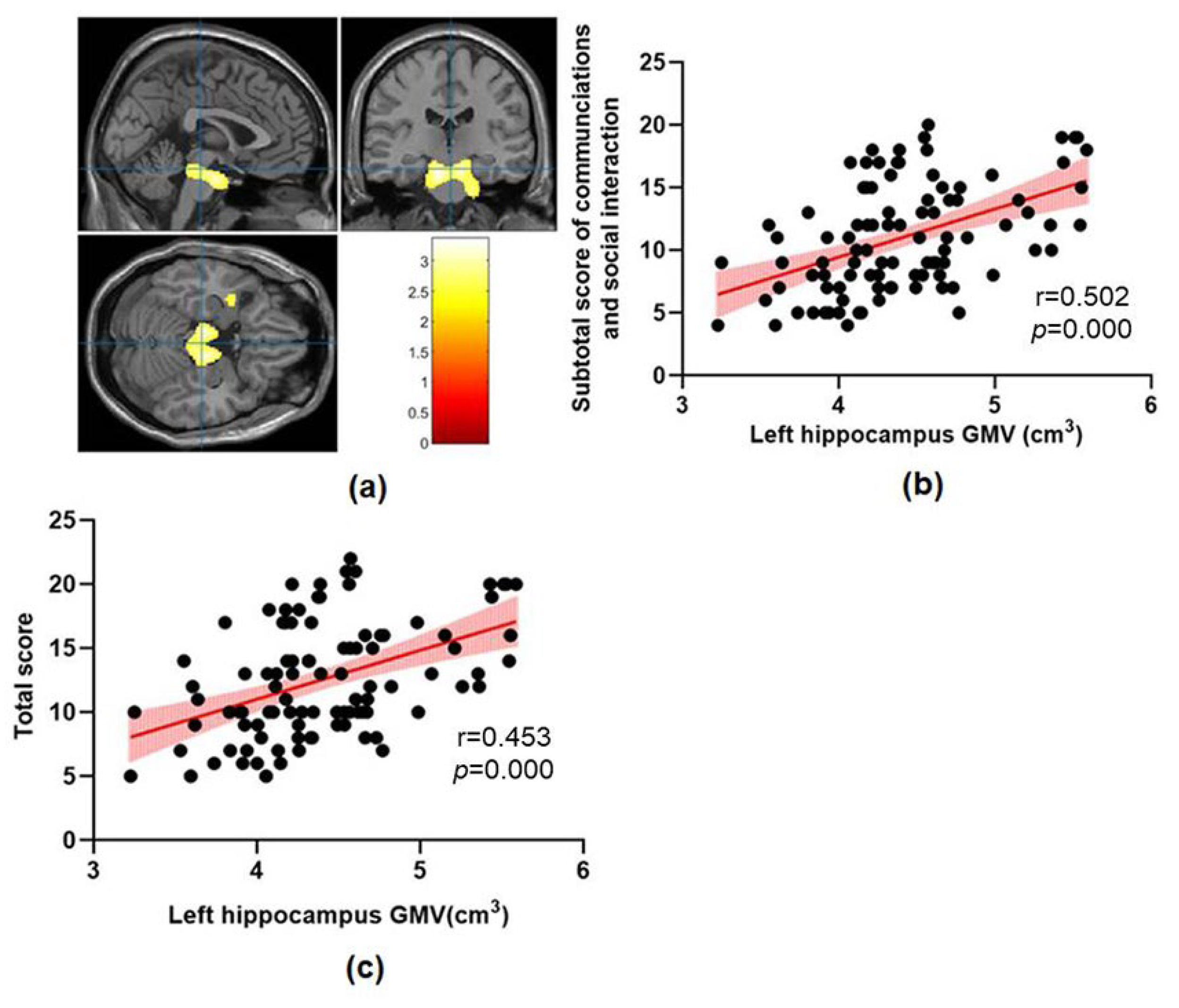 Brain Autism Spectrum Mini Brain' Study Reveals Possible Key Link To