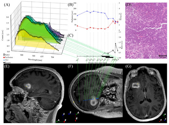 Combined Use of Frameless Neuronavigation and In Situ Optical Guidance ...