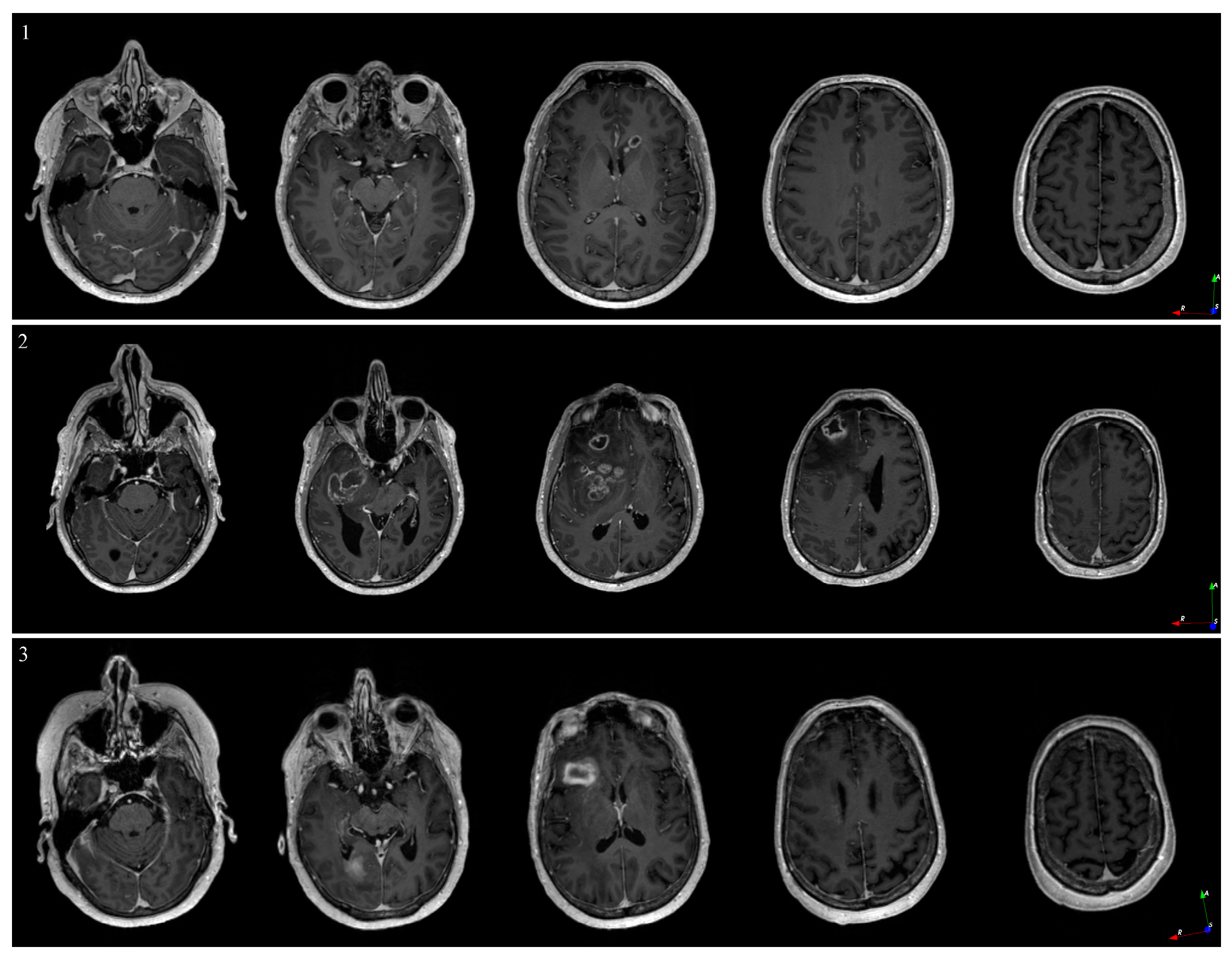 Combined Use of Frameless Neuronavigation and In Situ Optical Guidance ...