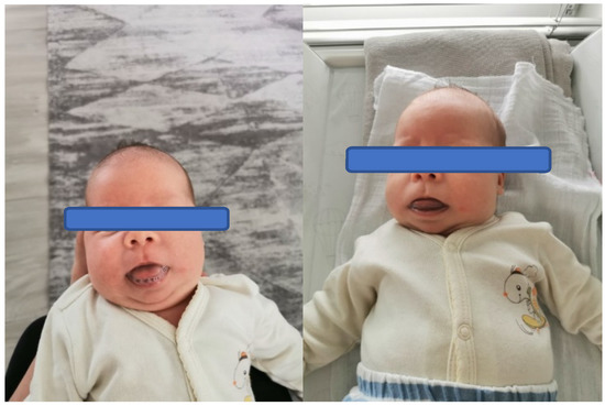 Application of Original Therapy for Stimulation of Oral Areas ...