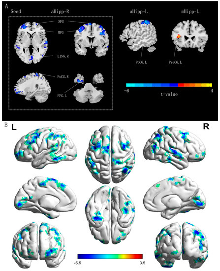Changes in Functional Connectivity of Hippocampal Subregions in ...