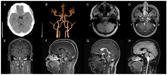 A Case of Craniocervical Junction Arteriovenous Fistulas with a Brainstem Mass Lesion on Imaging ...