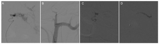 A Case of Craniocervical Junction Arteriovenous Fistulas with a ...