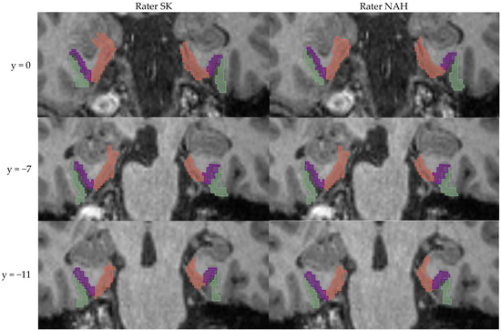 Excellent Interrater Reliability for Manual Segmentation of the Medial ...