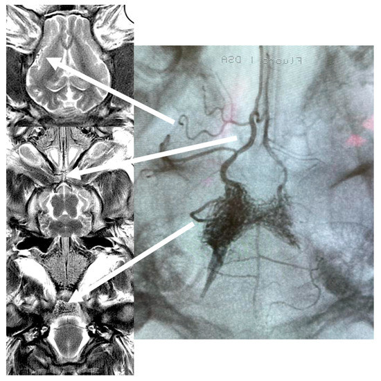 Real-Time MRI Monitoring of Liquid Embolic Agent (Onyx) Injection in a ...