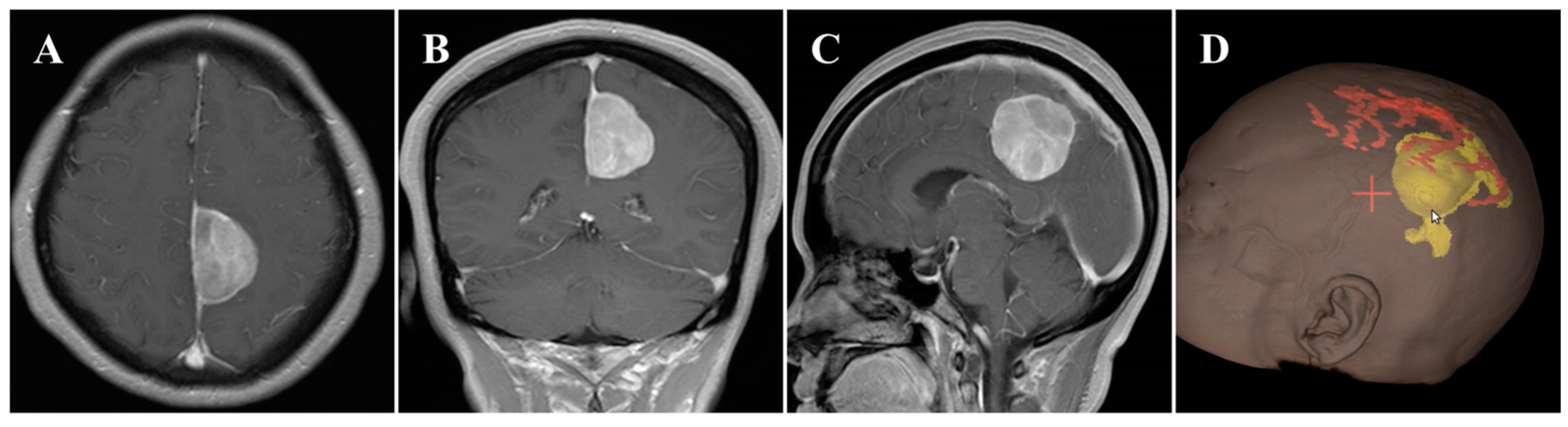 Endoscopic Ipsilateral Interhemispheric Approach for Middle-Third ...