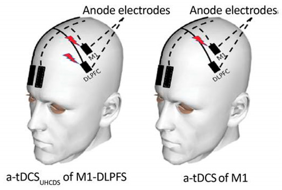 The Effect of Uni-Hemispheric Dual-Site Anodal tDCS on Brain Metabolic Changes in Stroke ...